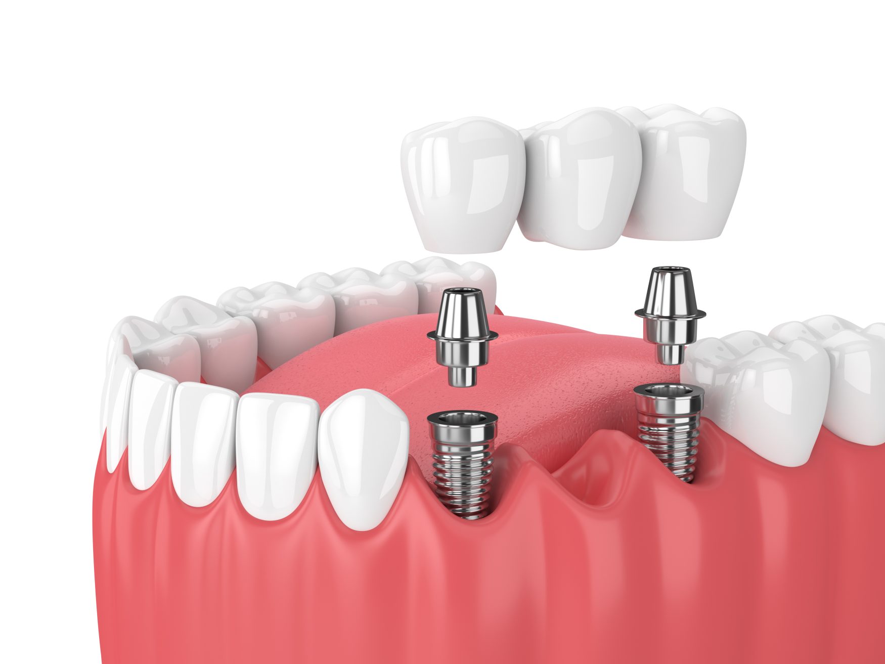 Dental Implant Services - Southeast Louisiana & South Mississippi ...